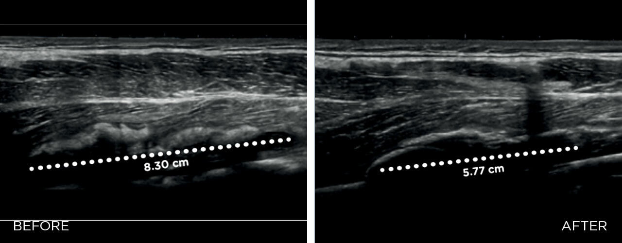 High Intensity Laser - Muscle Injury | ISOMATIC Integrative Health Centre