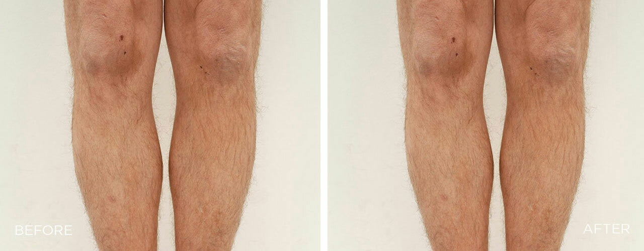 Super Inductive System - Muscle Atrophy | ISOMATIC Integrative Health ...
