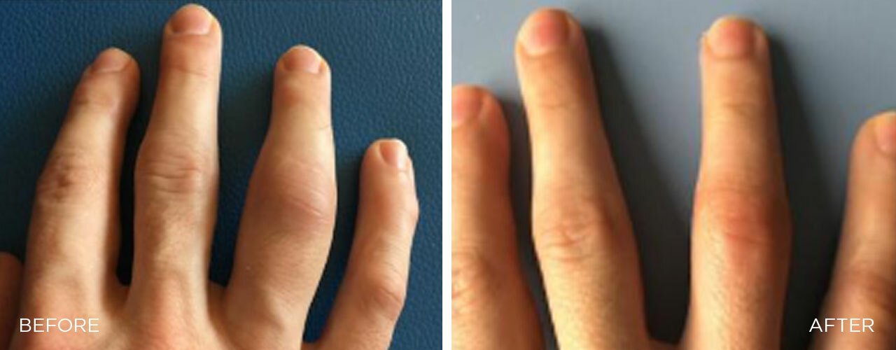 Super Inductive System - Bone Edema | ISOMATIC Integrative Health Centre